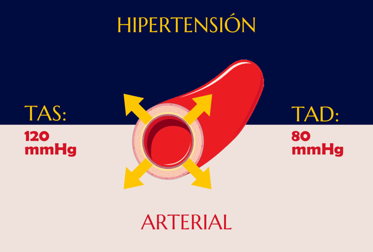 Definición De La Hipertensión Arterial – XFQS